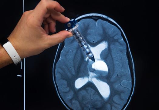 Spectrum Health uses NICO technology for minimally invasive removal of ...