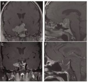 Tumors and Cysts via Transnasal Approach - NICO Corporation