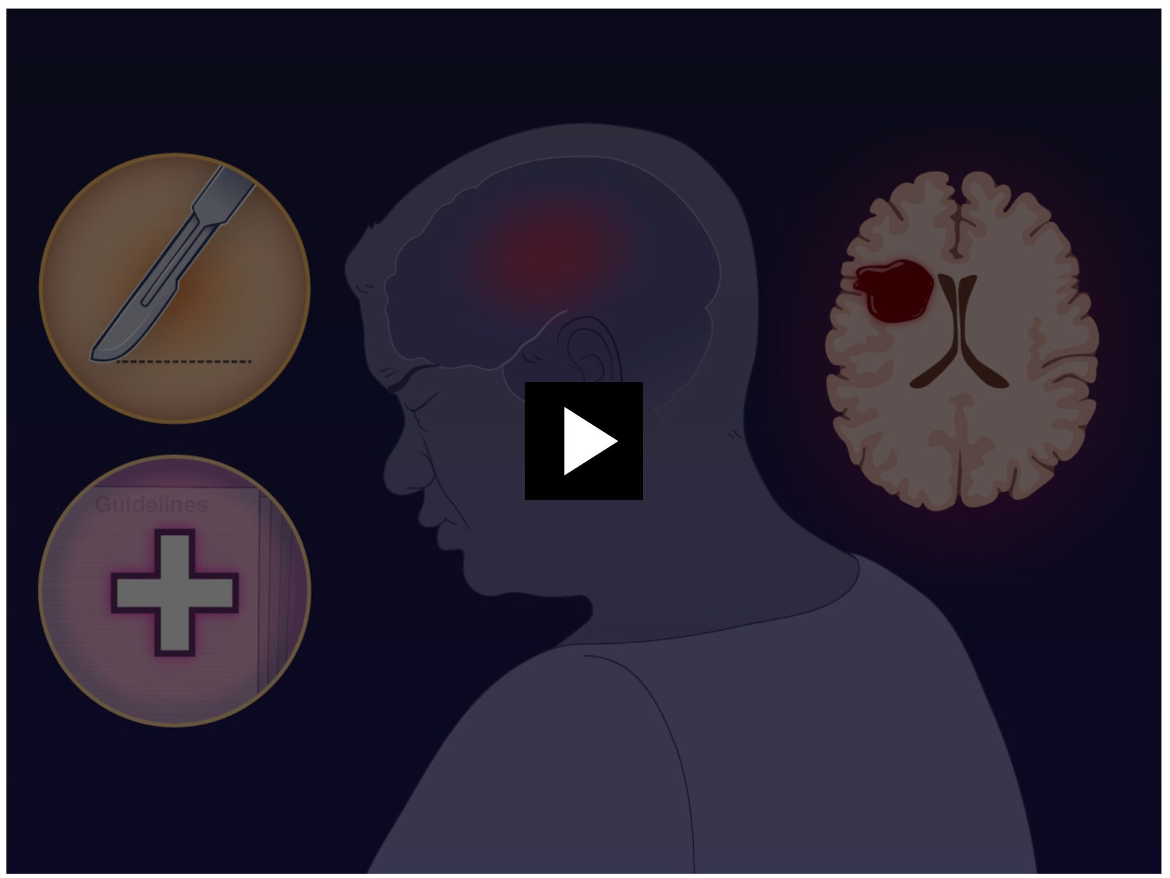 NEJM QUICK TAKE: Early Minimally Invasive Removal of Intracerebral ...
